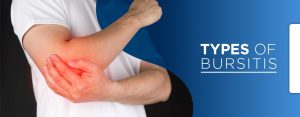 Types of Bursitis Explained | OrthoBethesda