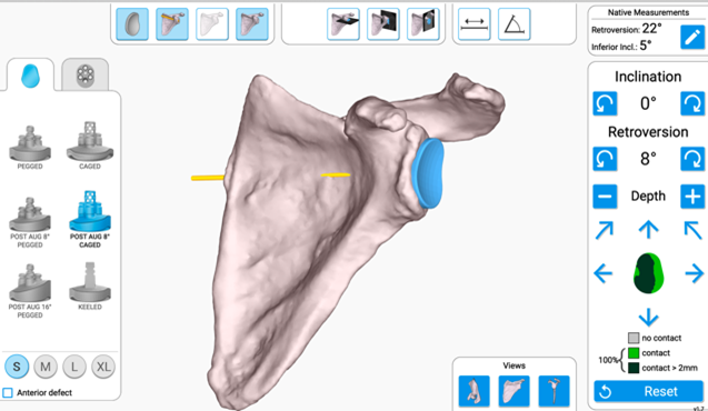 How Dr. Craig Miller Uses New Technology to Improve Shoulder Surgery